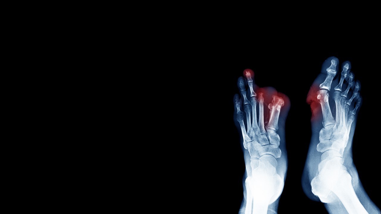 LSTA12 (HONEDRA®) - Critical Limb Ischemia & Buerger's Disease ...